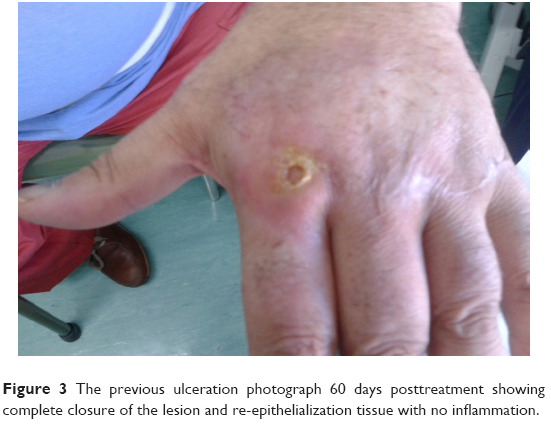 Chemotherapy Extravasation