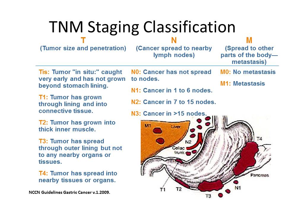 Gastric Cancer ONA gastric-cancer-ona